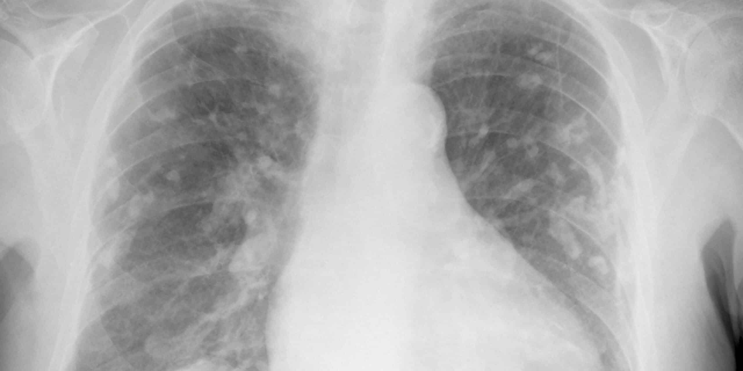 Pleural Plaques : Symptoms, Causes, Risks & Diagnosis